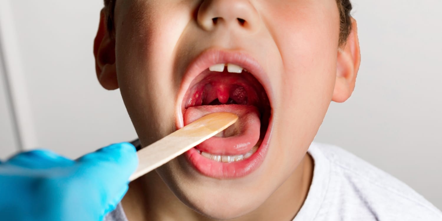 Vorsicht, ansteckend: Was passiert, wenn man Streptokokken hat?